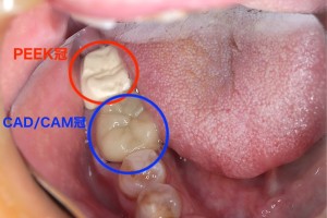 奥歯も保険適用で白い歯に！PEEK冠とは？CAD/CAM冠との違いも解説 | 愛媛県松山の歯医者 もりもと歯科クリニック